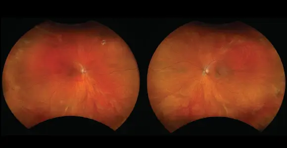 Clinical Papers and Research Using Optos Ultra-widefield Devices