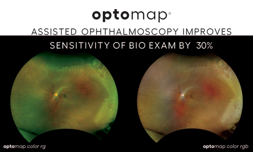 Clinical Papers and Research Using Optos Ultra-widefield Devices
