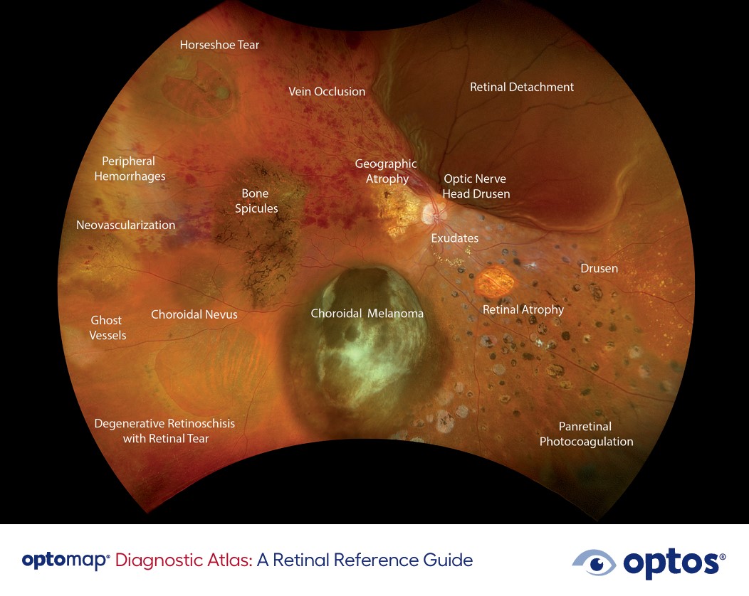 Diagnostic and Educational Tools for optomap | Access Materials