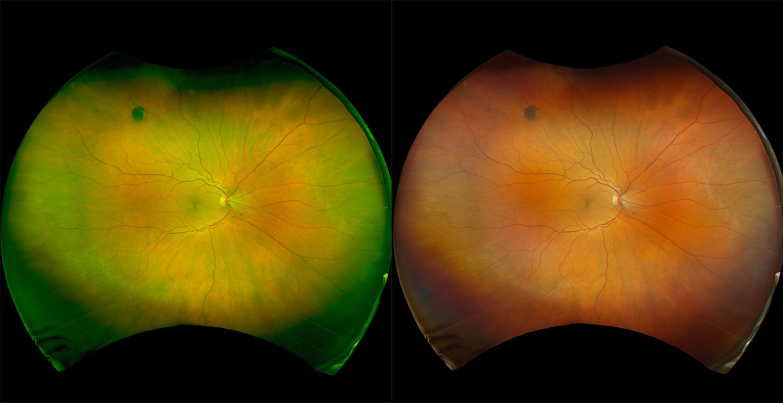 Congenital Hypertrophy of the Retinal Pigment Epithelium (CHRPE)