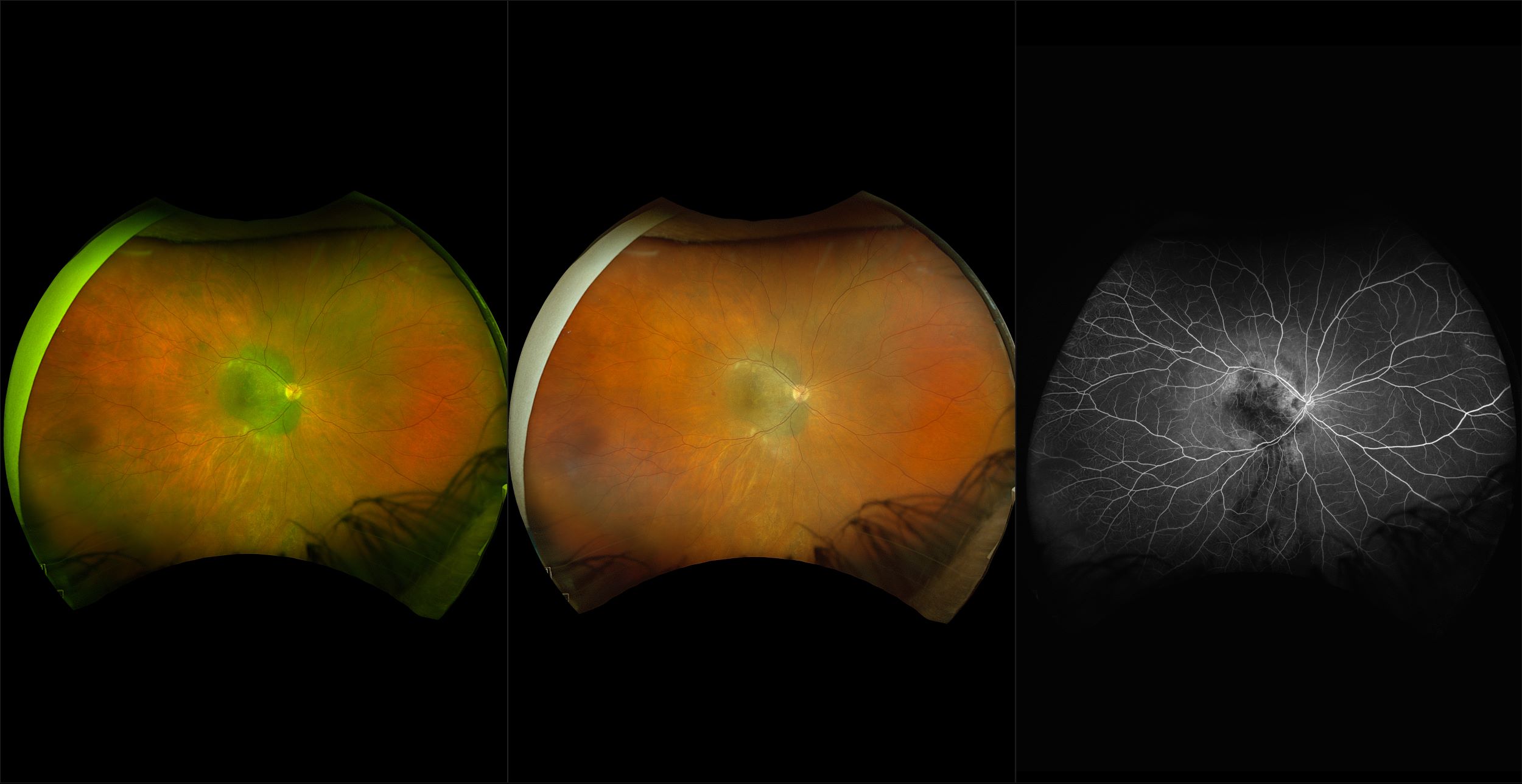 California - Retinitis Pigmentosa and Birdshot Retinopathy, RG, AF