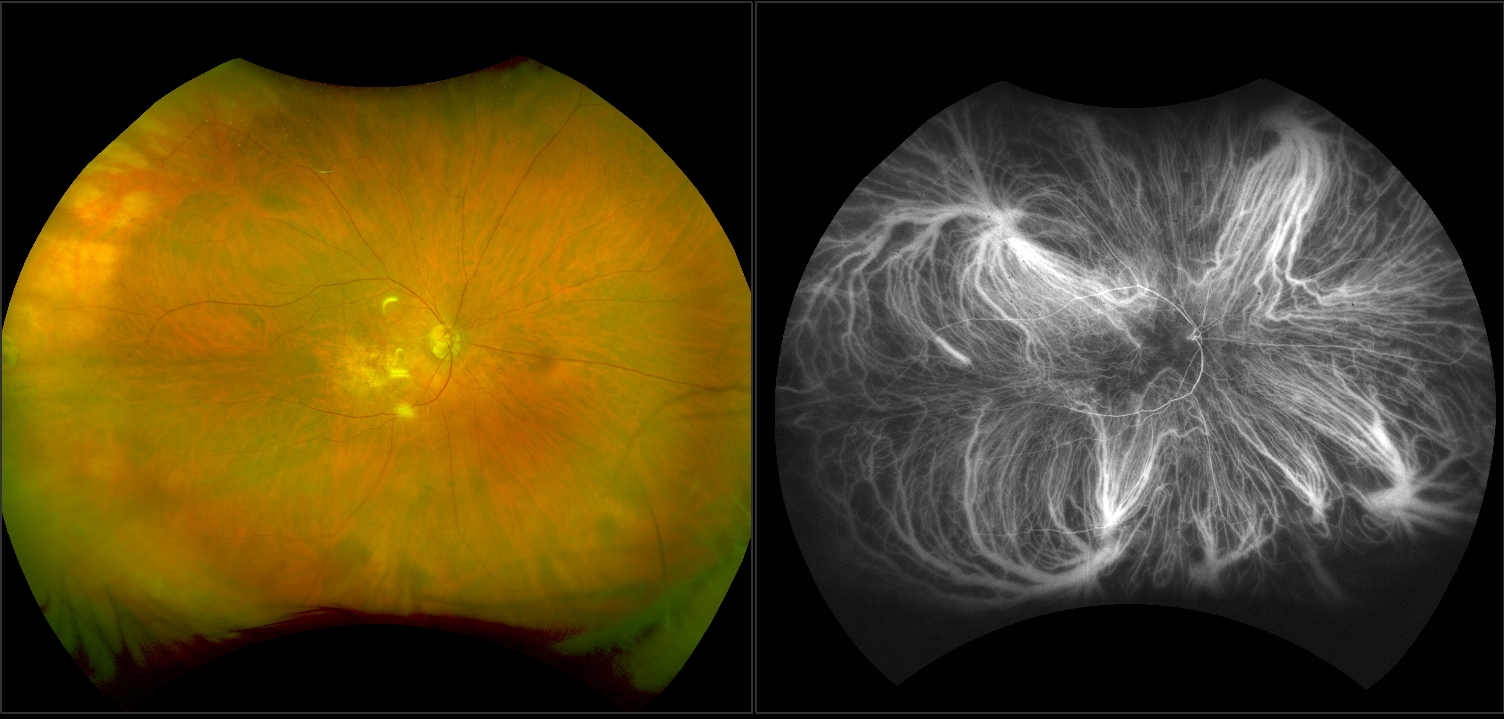 Age-related Macular Degeneration (AMD)