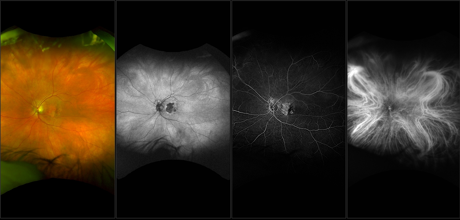 Age-related Macular Degeneration (AMD)