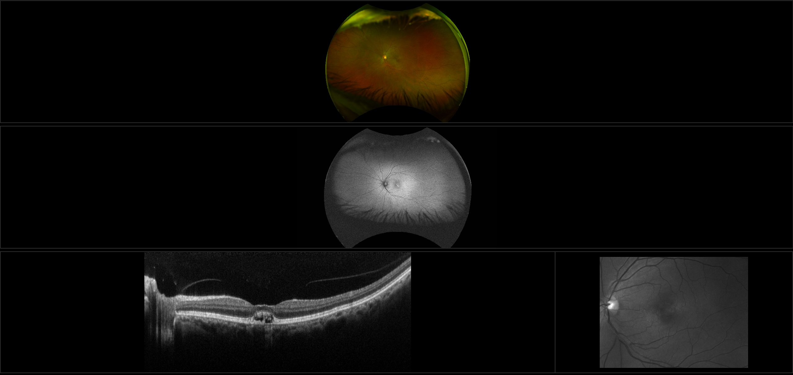 Age-related Macular Degeneration (AMD)
