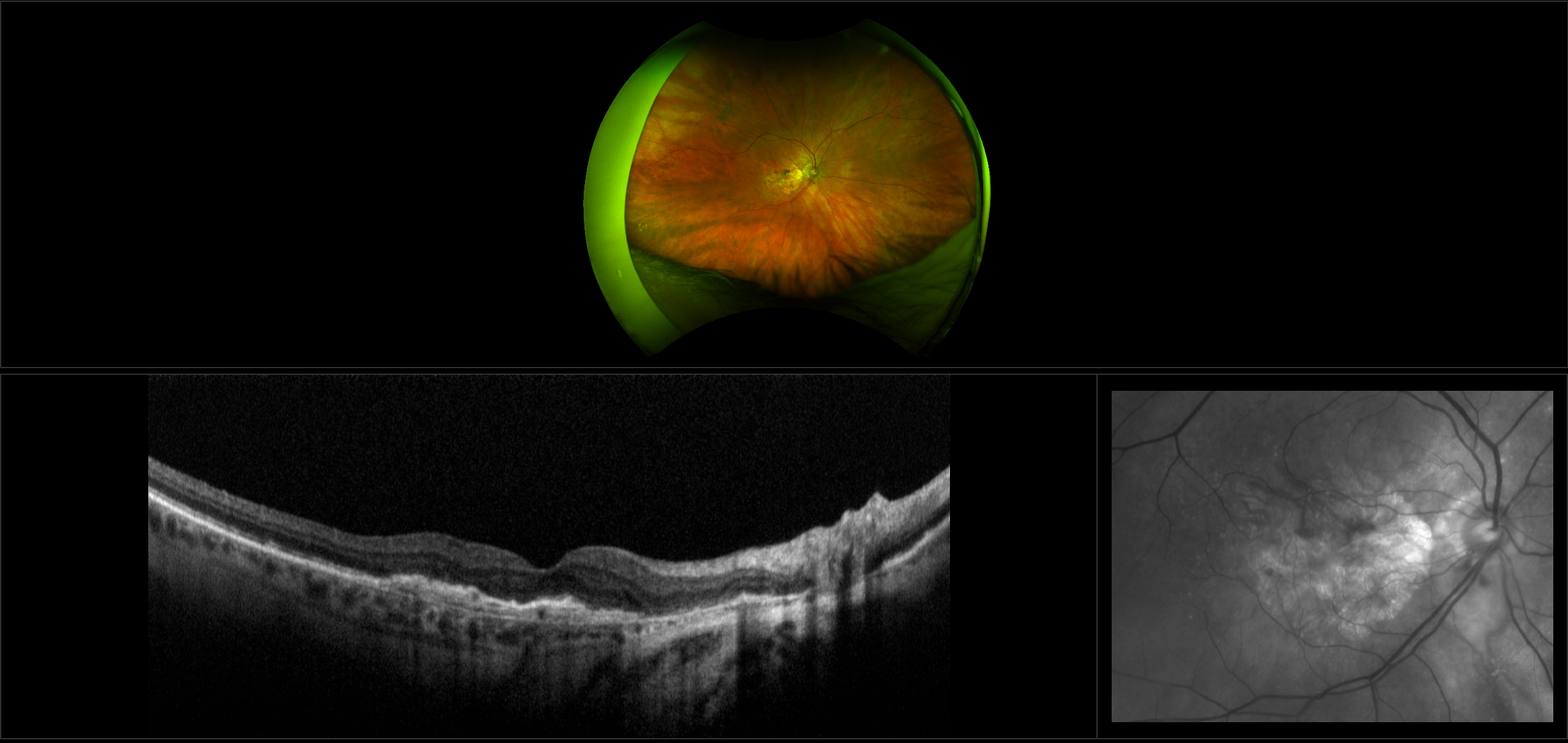 Age-related Macular Degeneration (AMD)