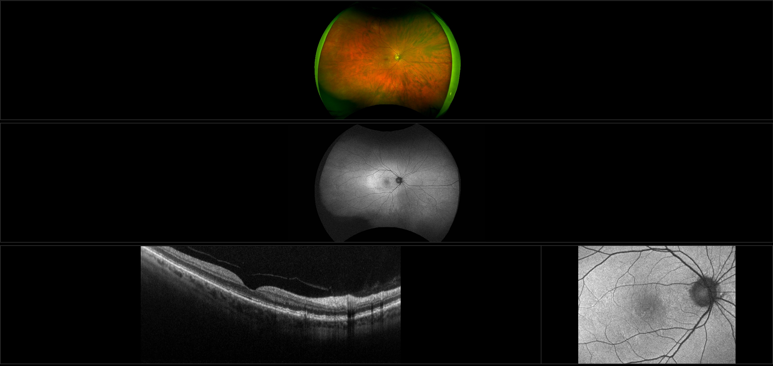 Age-related Macular Degeneration (AMD)