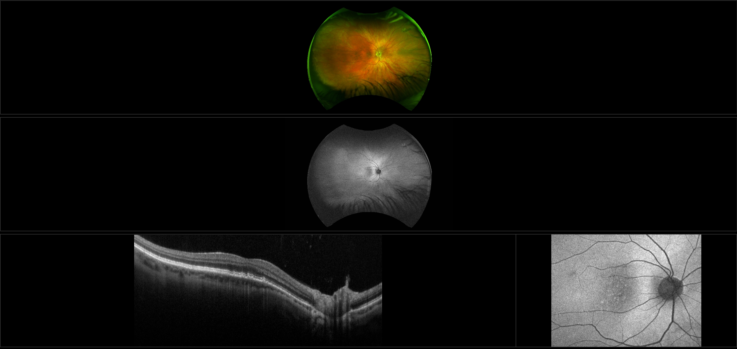 Age-related Macular Degeneration (AMD)