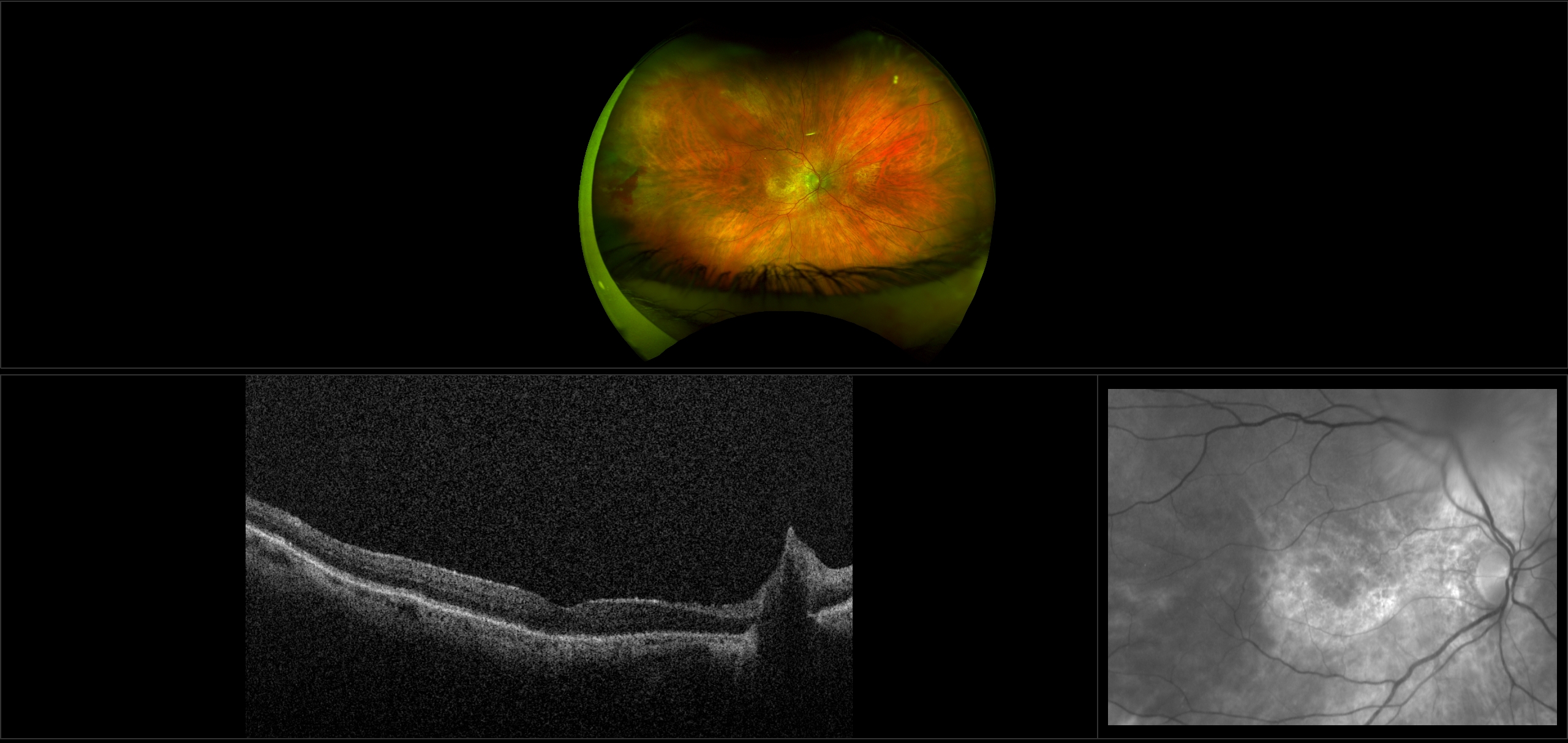 Age-related Macular Degeneration (AMD)