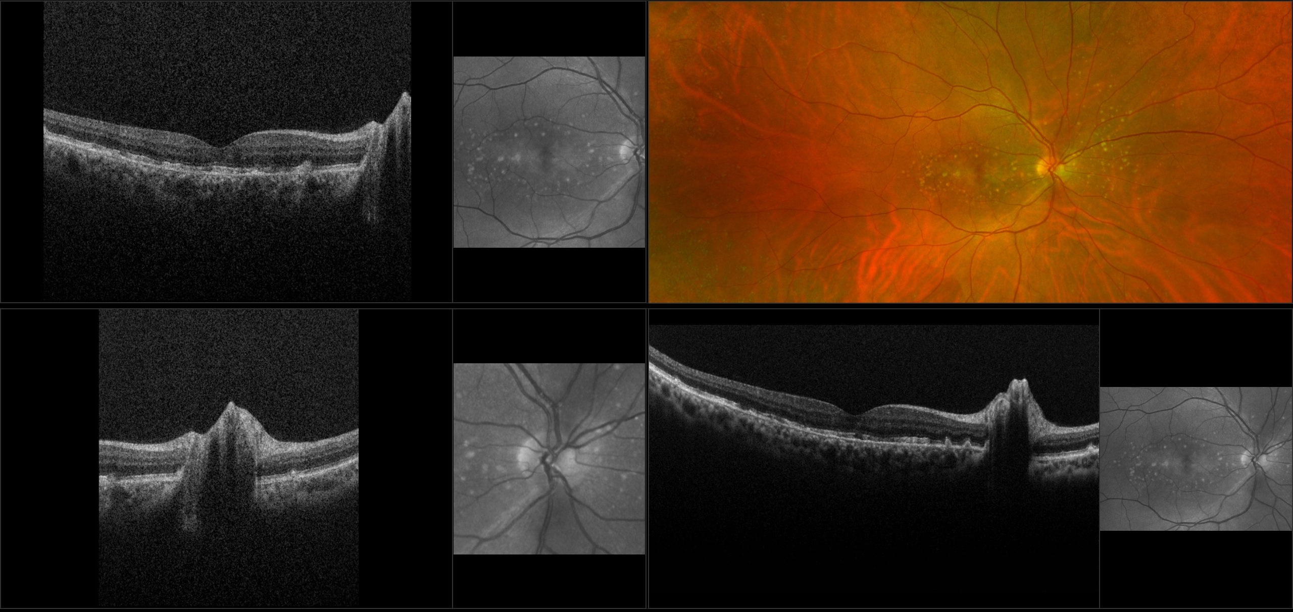Age-related Macular Degeneration (AMD)