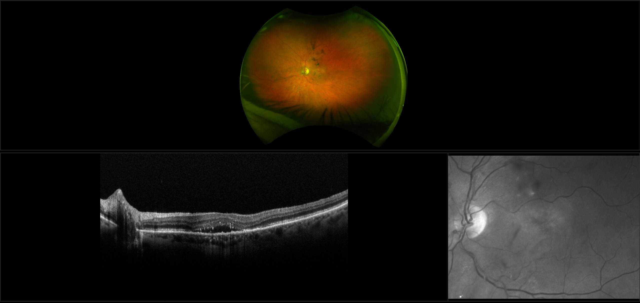 Age-related Macular Degeneration (AMD)