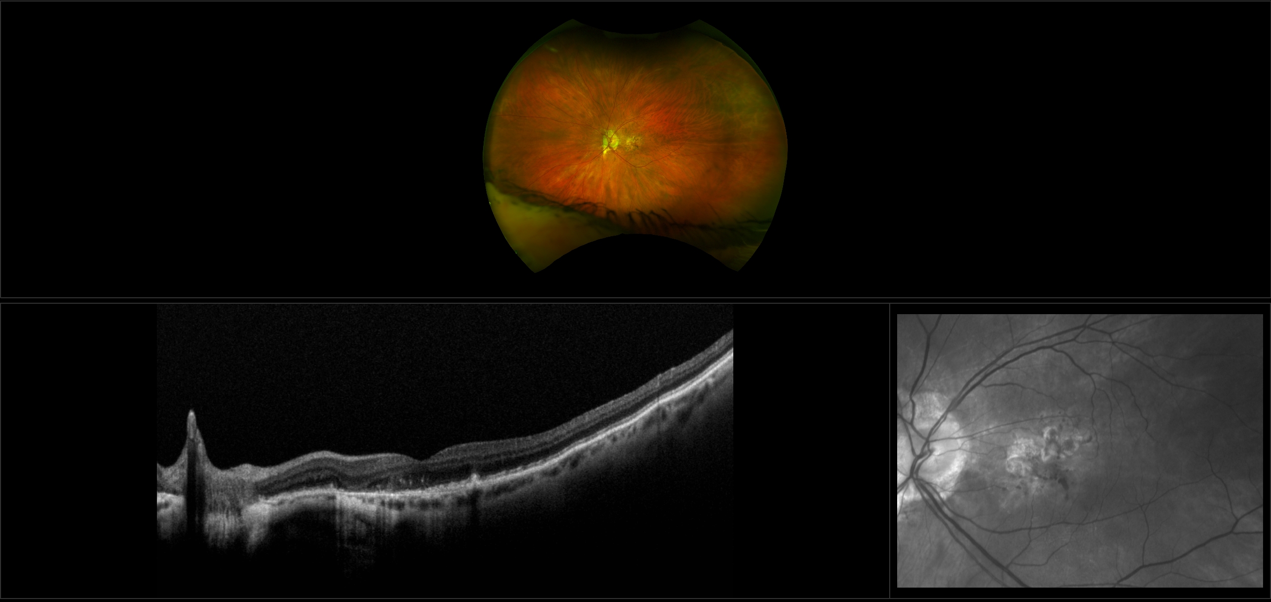 Age-related Macular Degeneration (AMD)