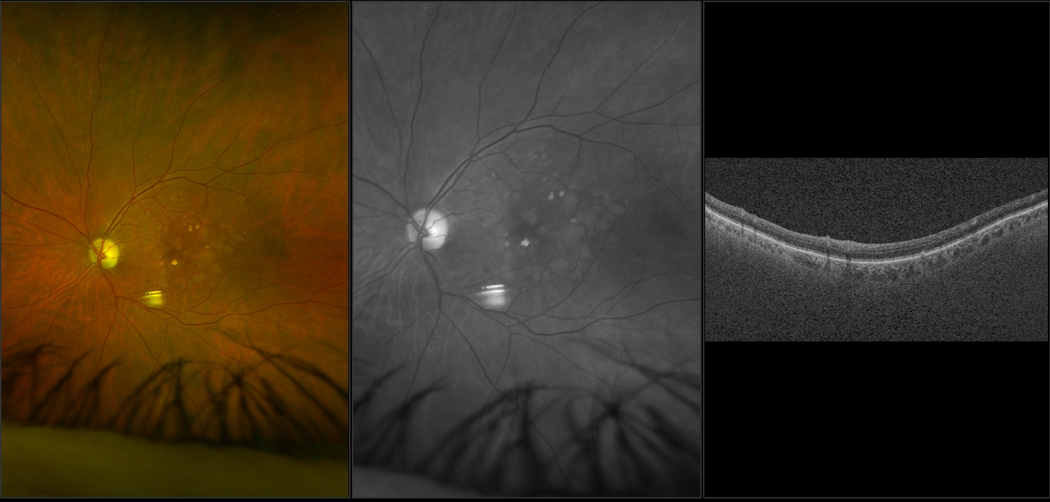 Age-related Macular Degeneration (AMD)