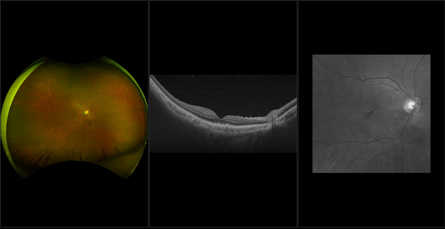 Age-related Macular Degeneration (AMD)