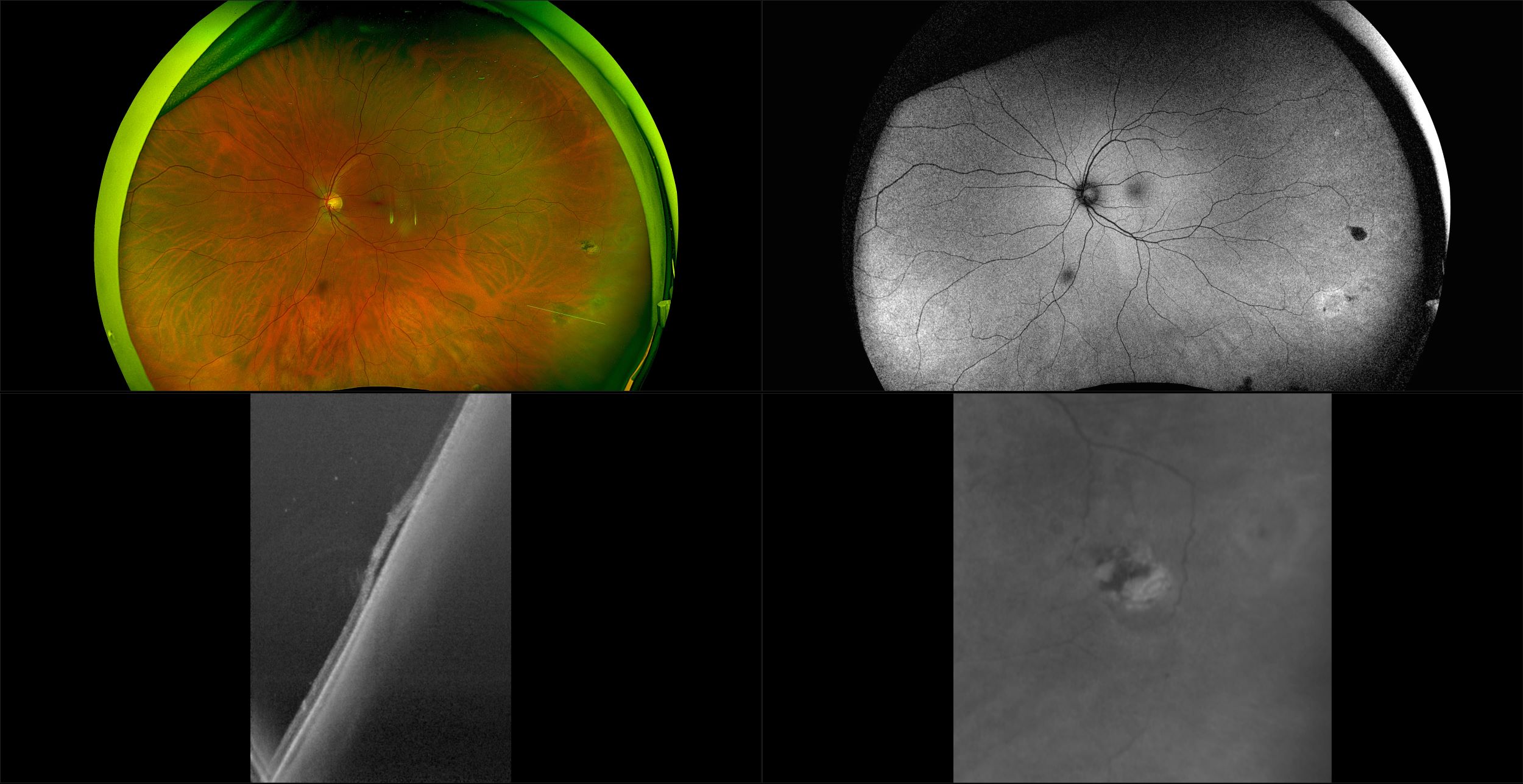 California - Peripheral Retinal Tear, RG