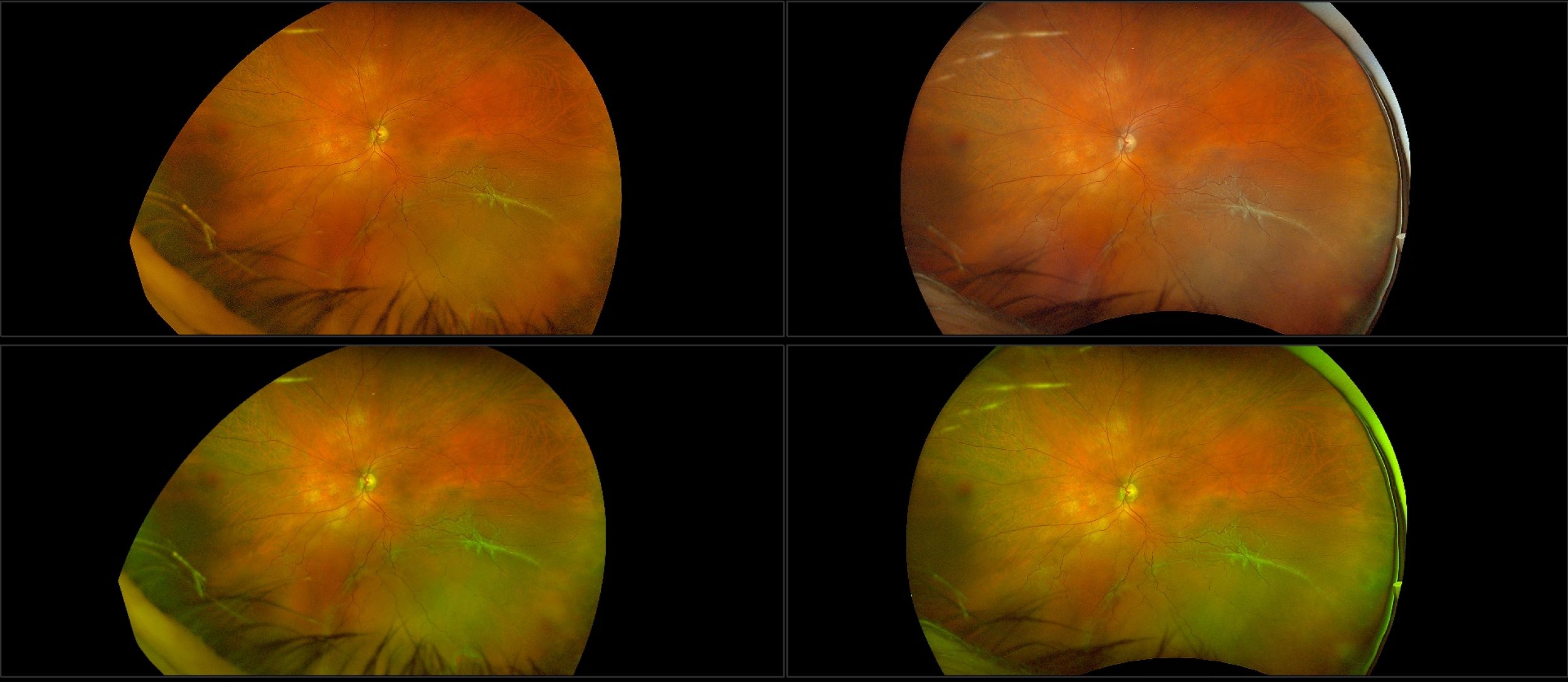 California - Repaired Retinal Detachment, RG, RGB, AF