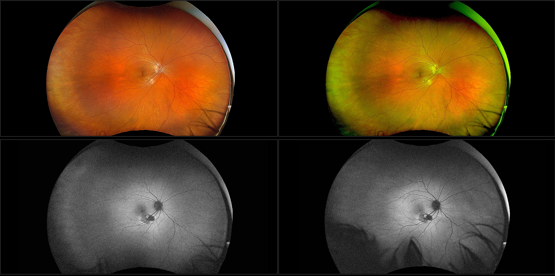 California - Idiopathic Macular Neovascularization, RG, RGB, BAF