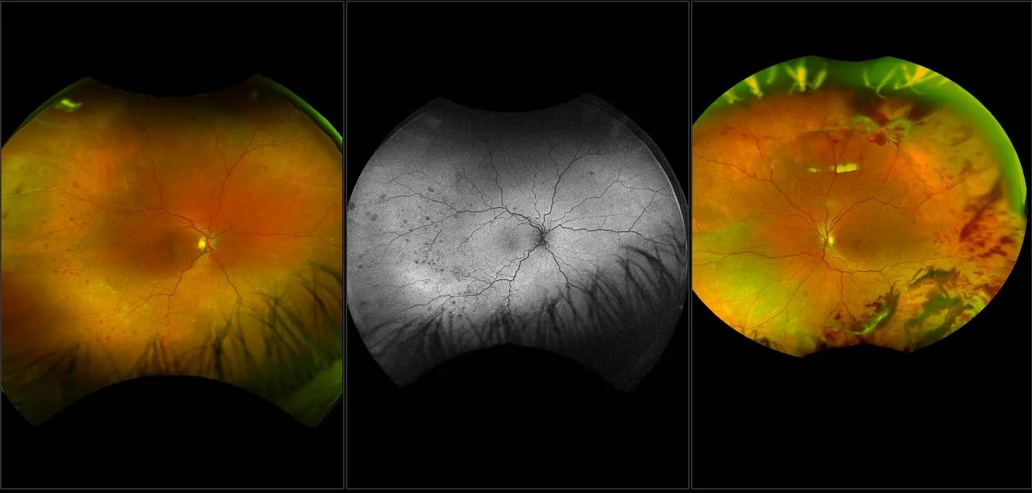 Diabetic Retinopathy - Case Study