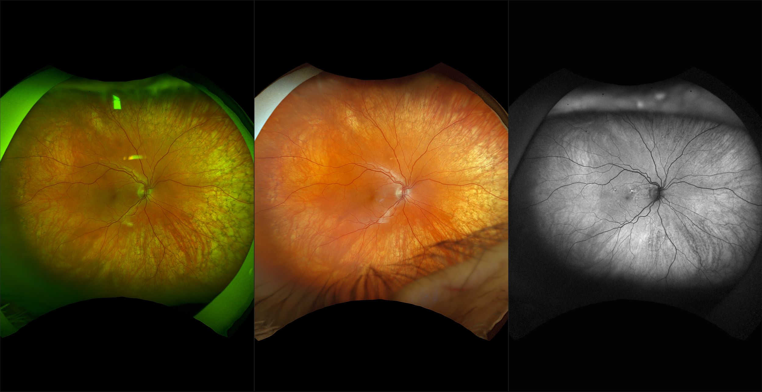 California - BRVO with Macular Edema, RG, RGB, FA