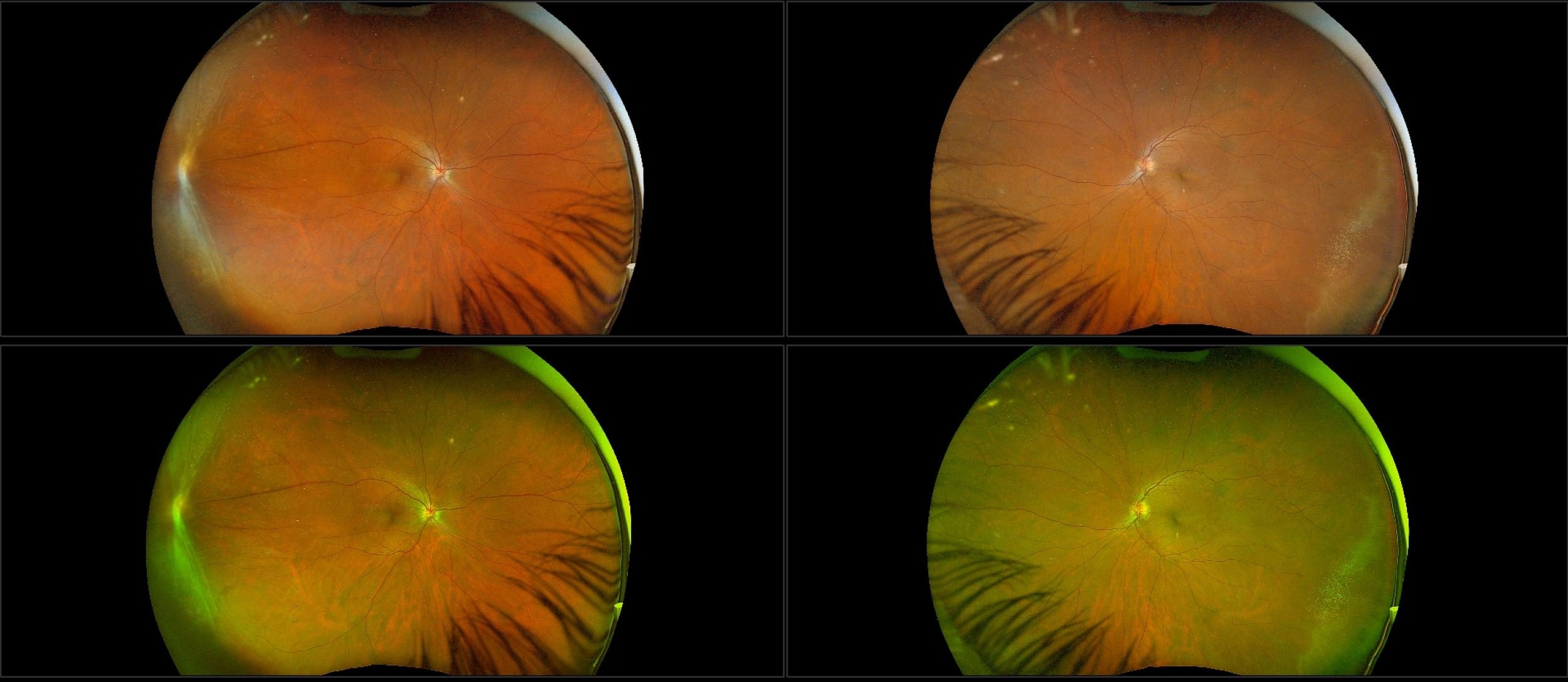 California - Retinoschisis, RG