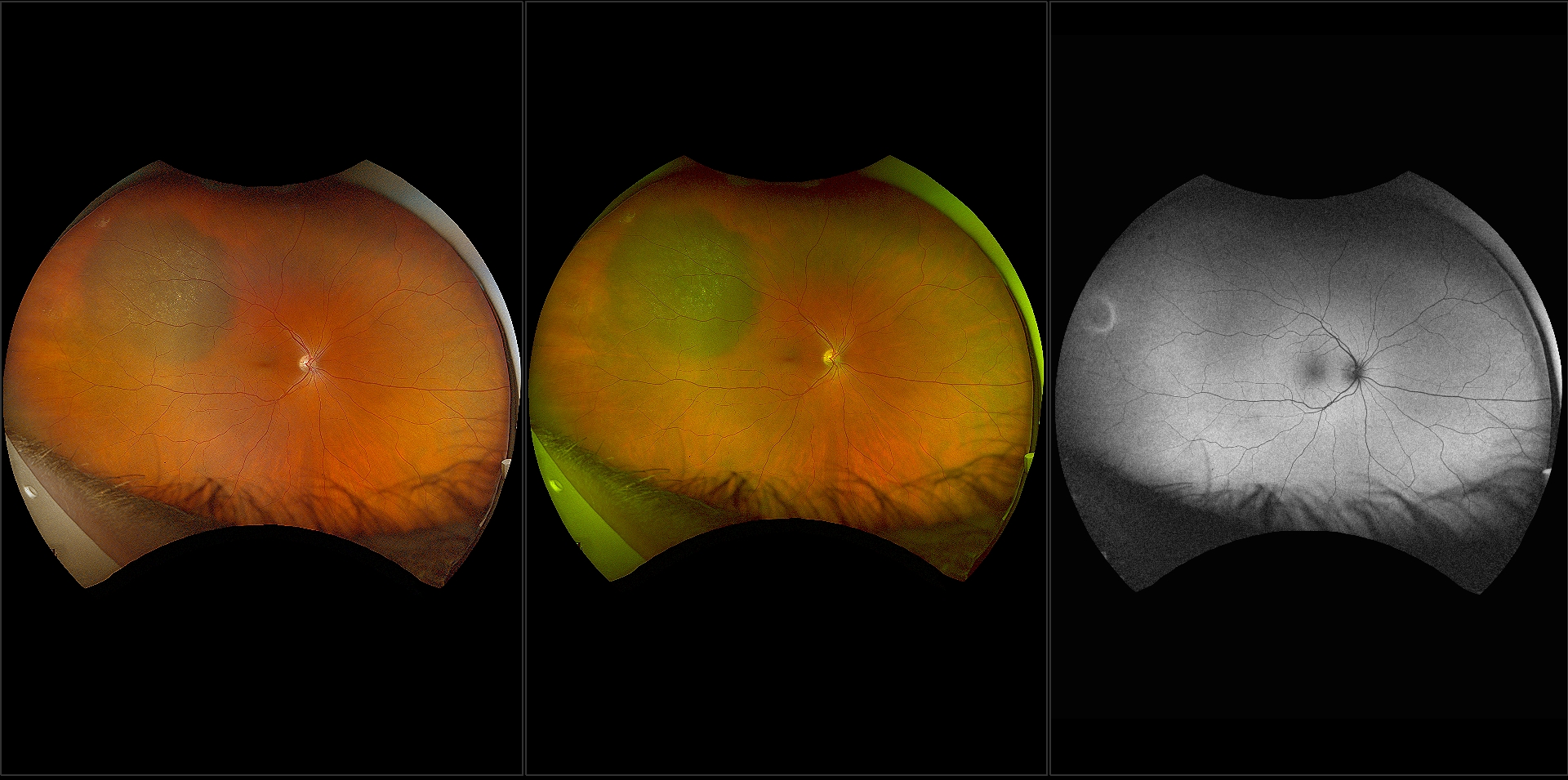 California - Choroidal Melanoma - Montage, RG, RGB, AF