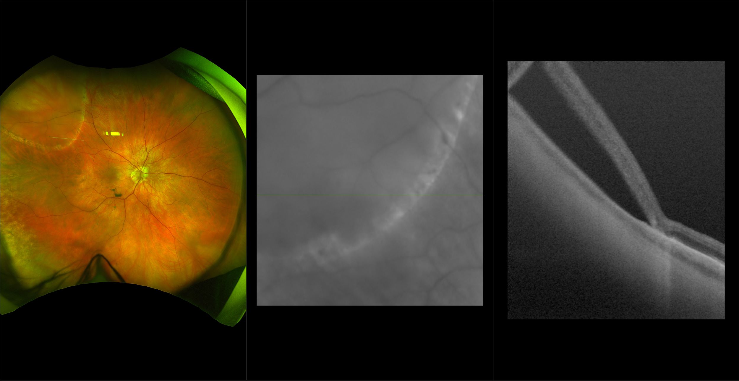 Silverstone - Atypical Retinal Schisis, RG, AF, OCT