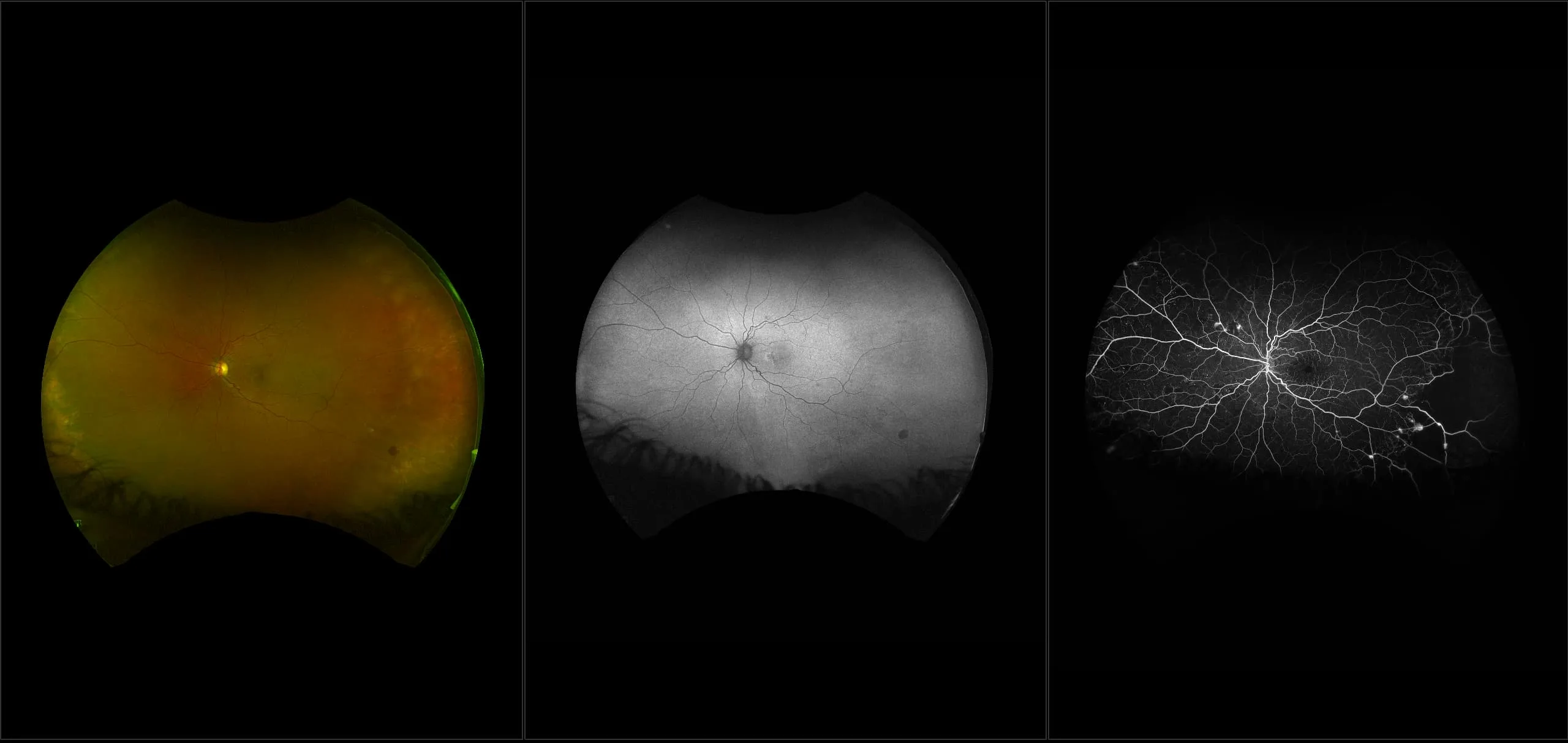 California - Mild Non-Proliferative Diabetic Retinopathy with Macular ...