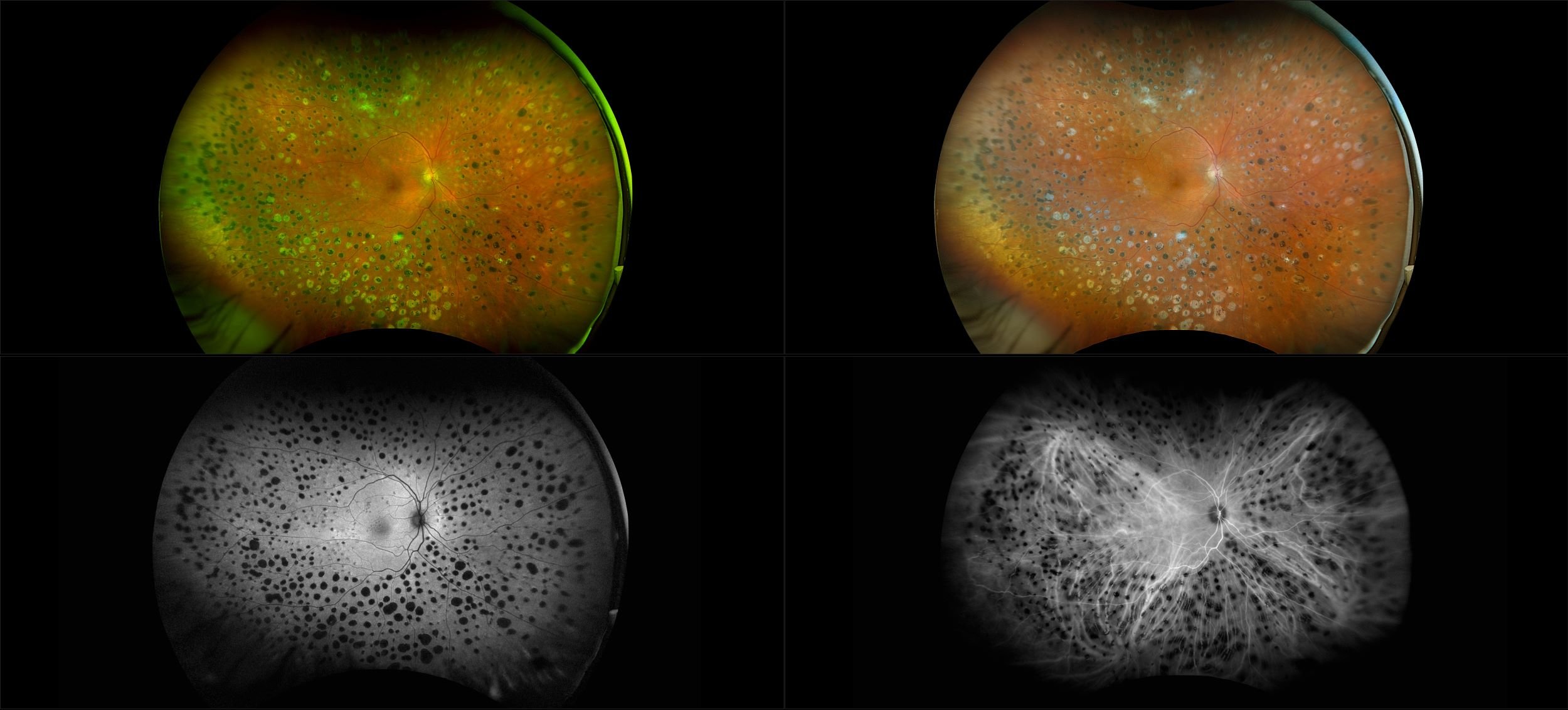 California - Diabetic Retinopathy, RG, RGB, AF
